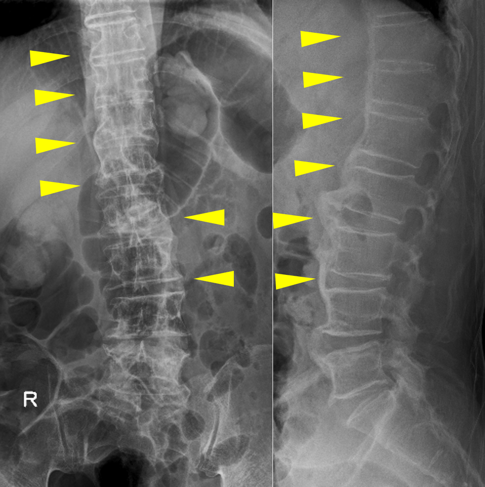 DISH(骨折その他) - 東京科学大学 整形外科