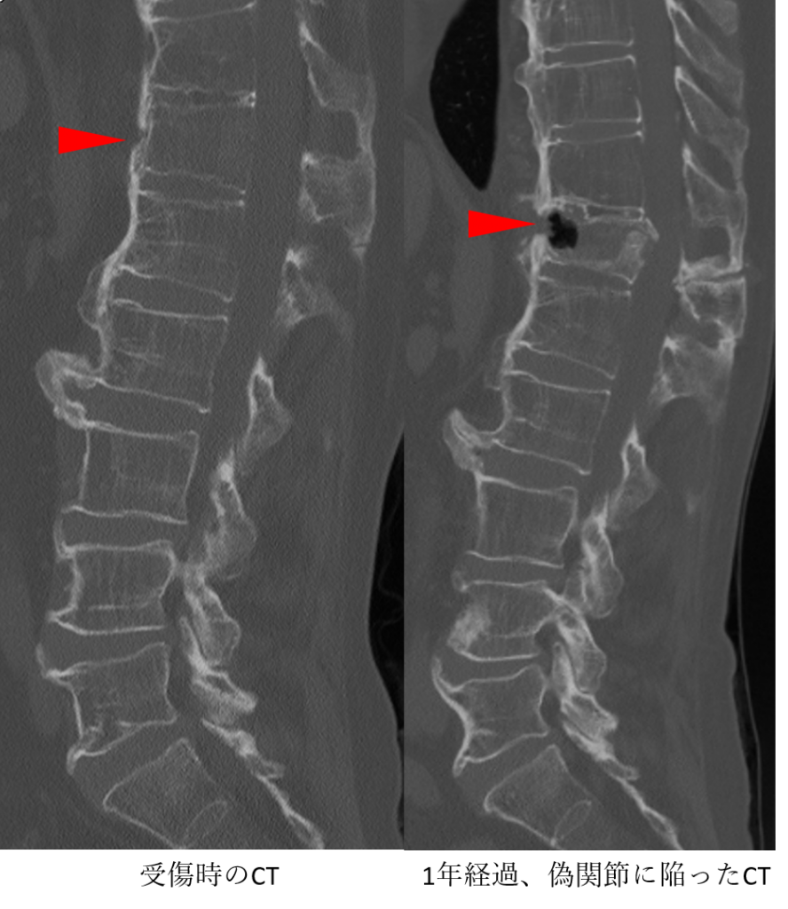 DISH(骨折その他) - 東京科学大学 整形外科