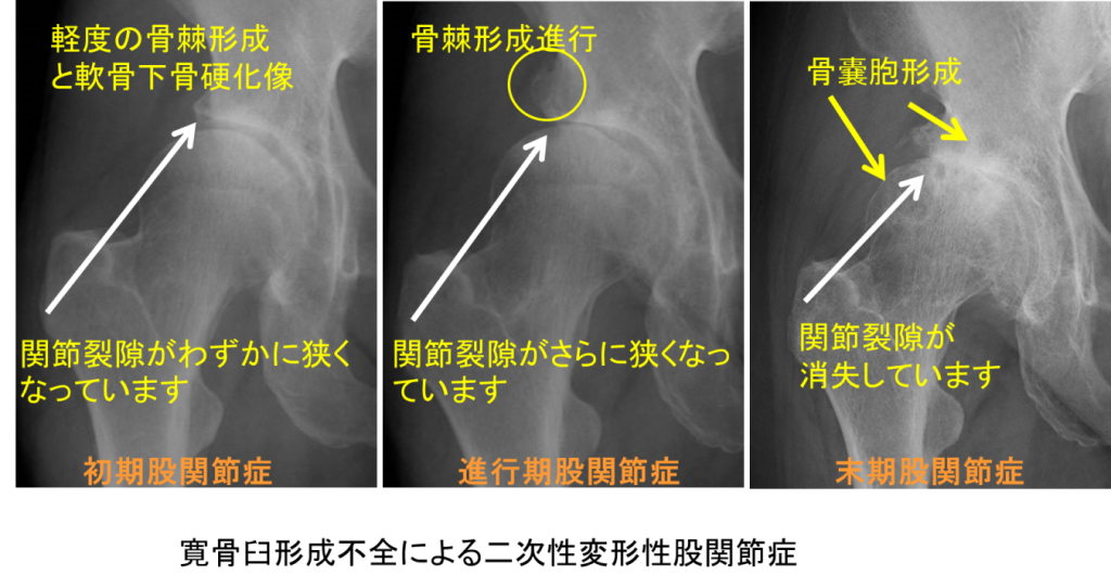 変形性股関節症 東京科学大学 整形外科