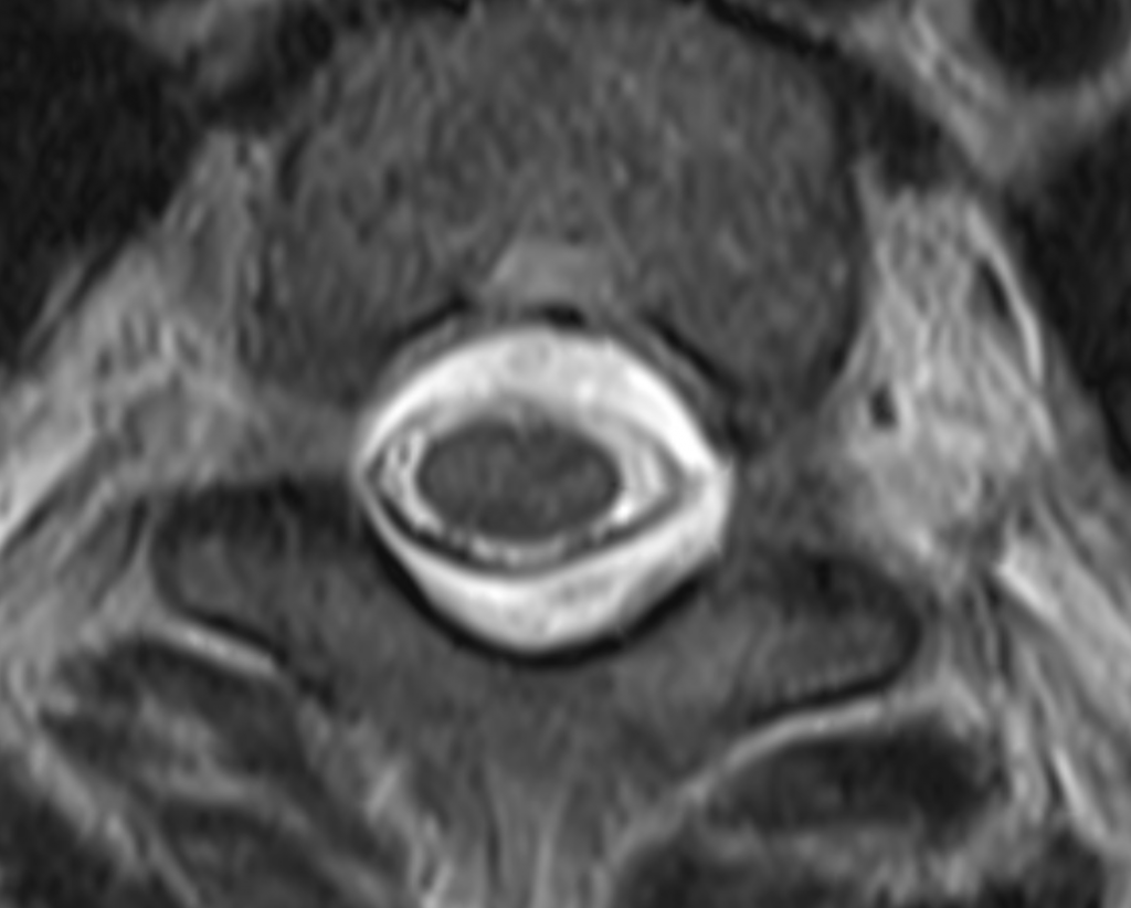 脳脊髄液漏出症, Duropathies （低髄液圧症候群、脳脊髄液減少症などを含む） - 東京科学大学 整形外科